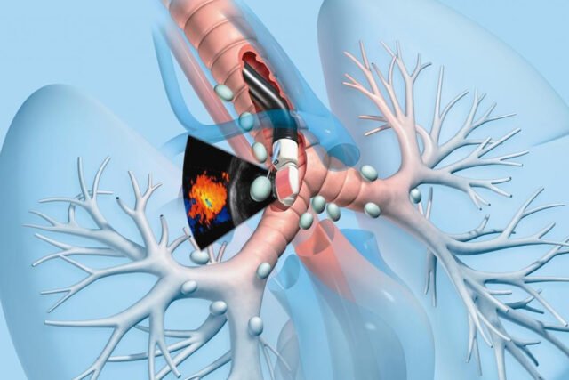 Diagnosing and Treating Endobrochial Ultrasound with Dr. Deep Modh