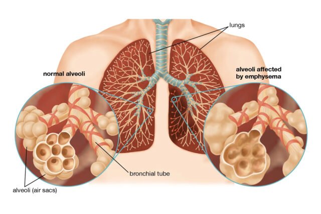 Comprehensive COPD and Emphysema Treatment and Diagnosis by Dr. Deep Modh