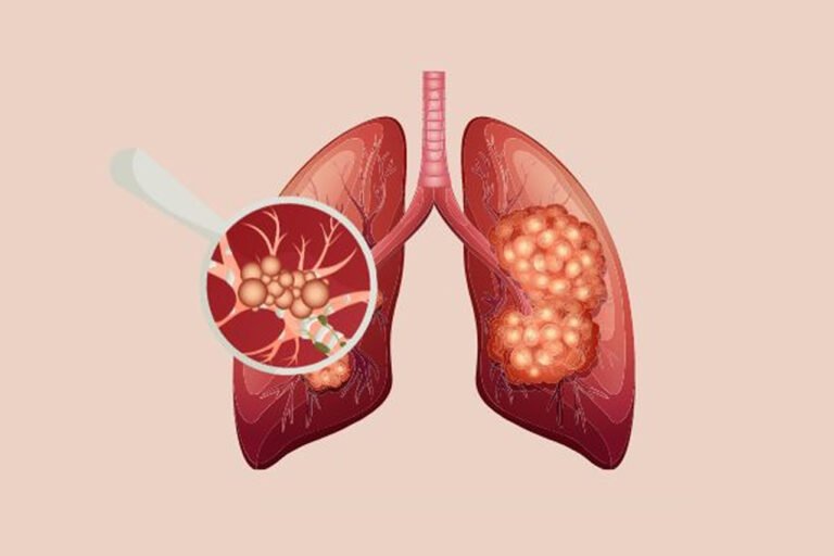 Expert Treatment and Precise Diagnosis of Interstitial Lung Disease (ILD)